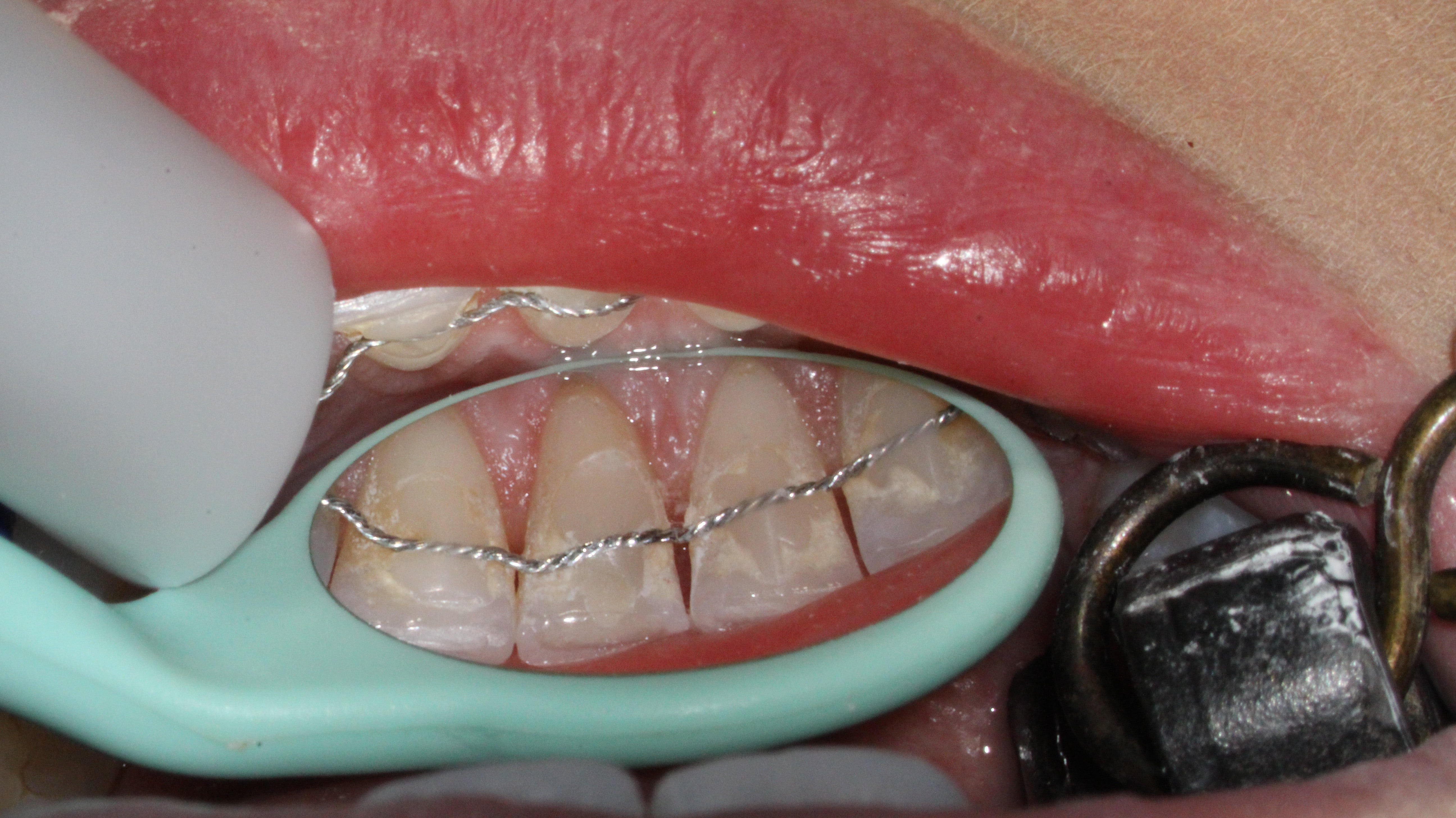 Electric motor for restorative and surgery.